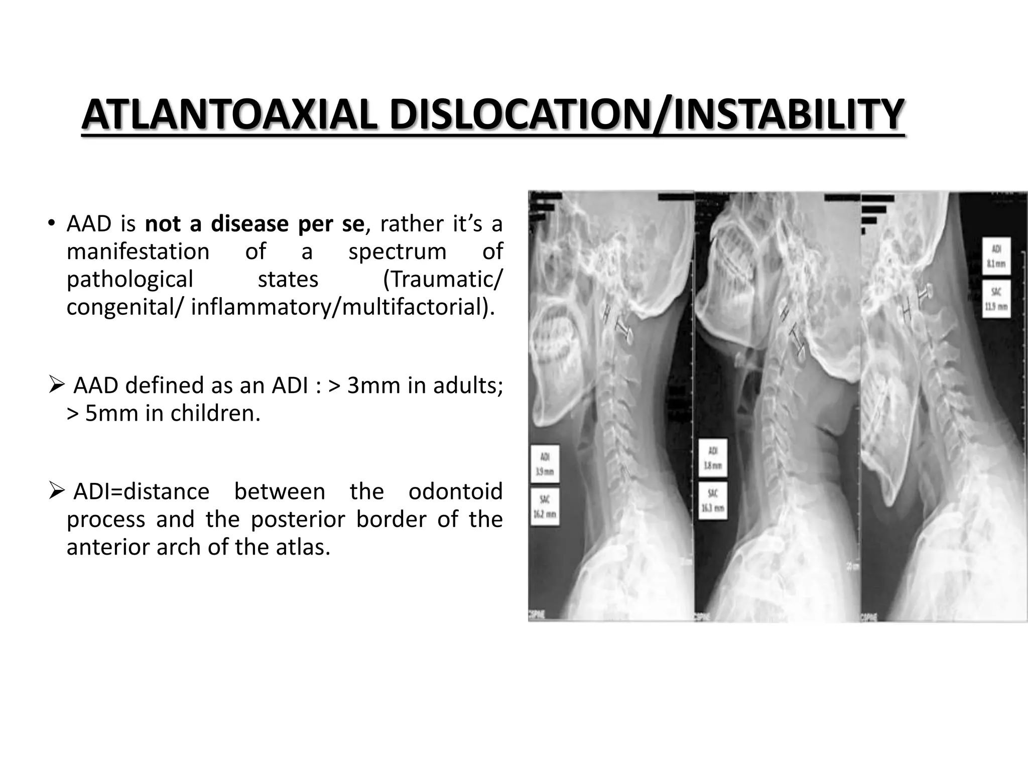 Imaging Cervico-vertebral junction: AAD with BI .pptx