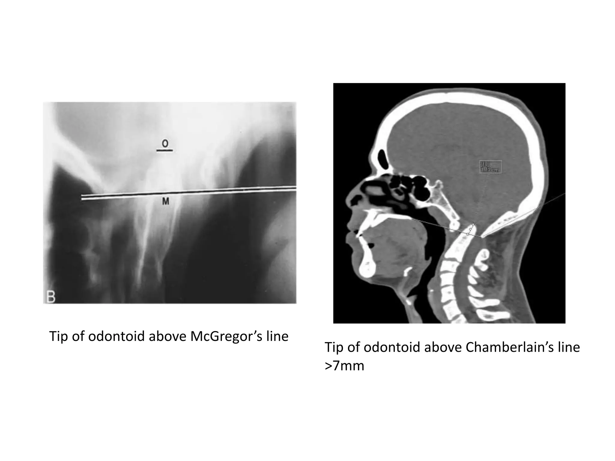 Imaging Cervico-vertebral junction: AAD with BI .pptx