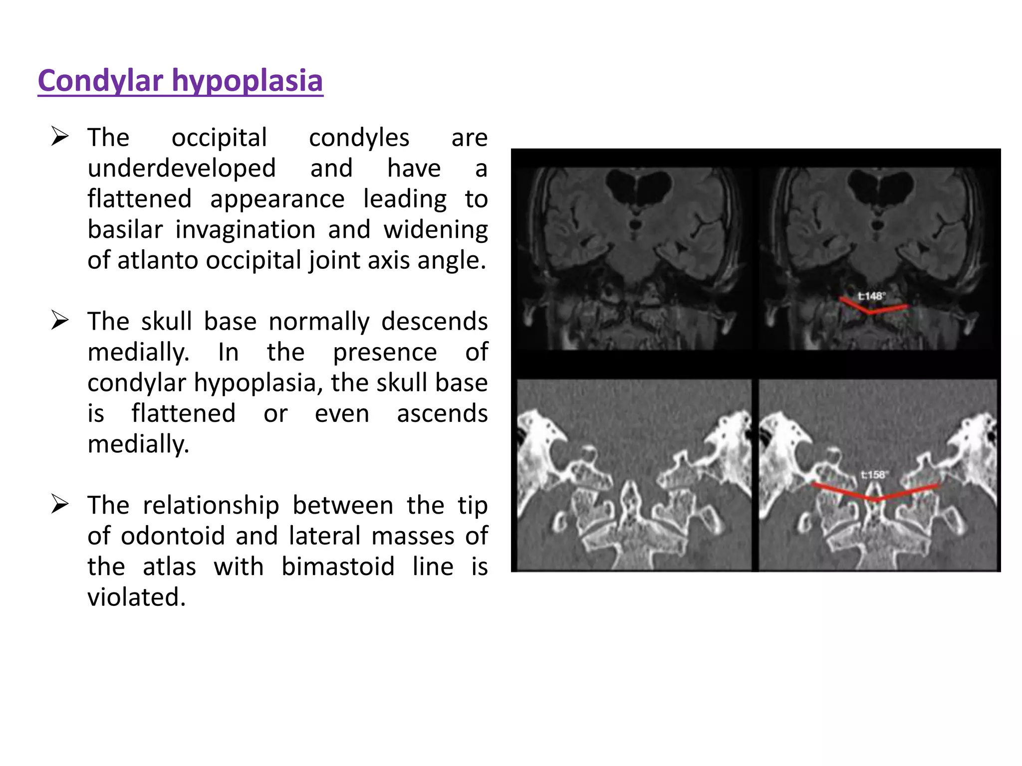 Imaging Cervico-vertebral junction: AAD with BI .pptx