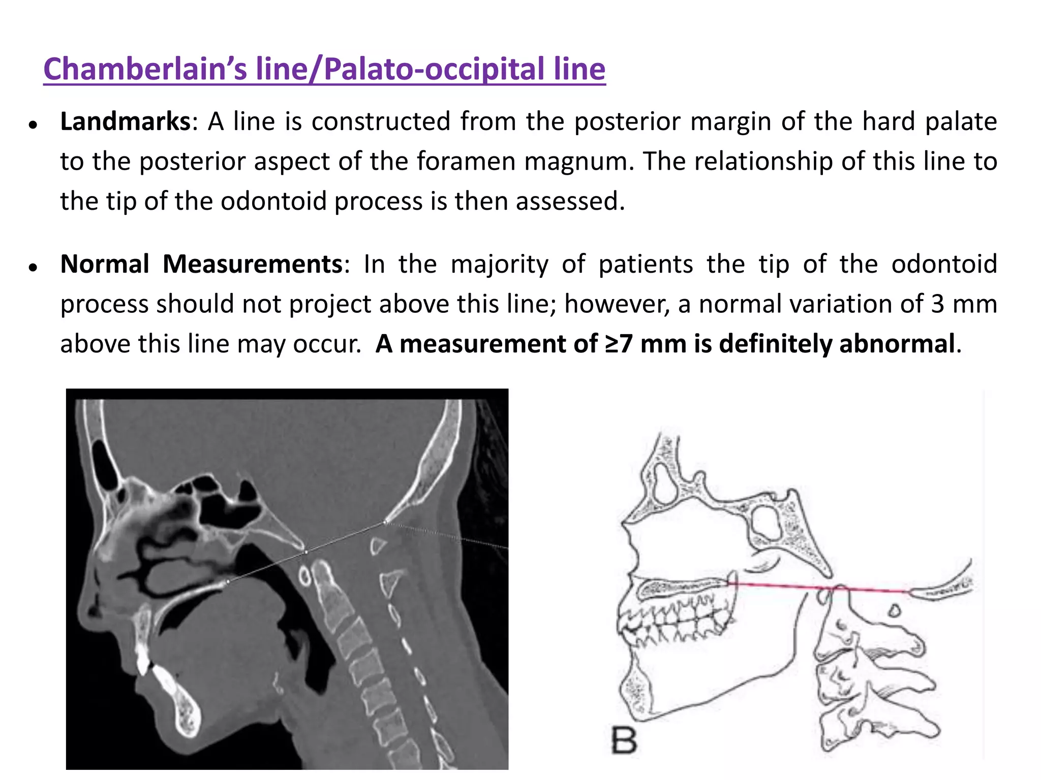Imaging Cervico-vertebral junction: AAD with BI .pptx