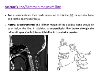 Imaging Cervico-vertebral junction: AAD with BI .pptx