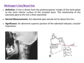 Imaging Cervico-vertebral junction: AAD with BI .pptx