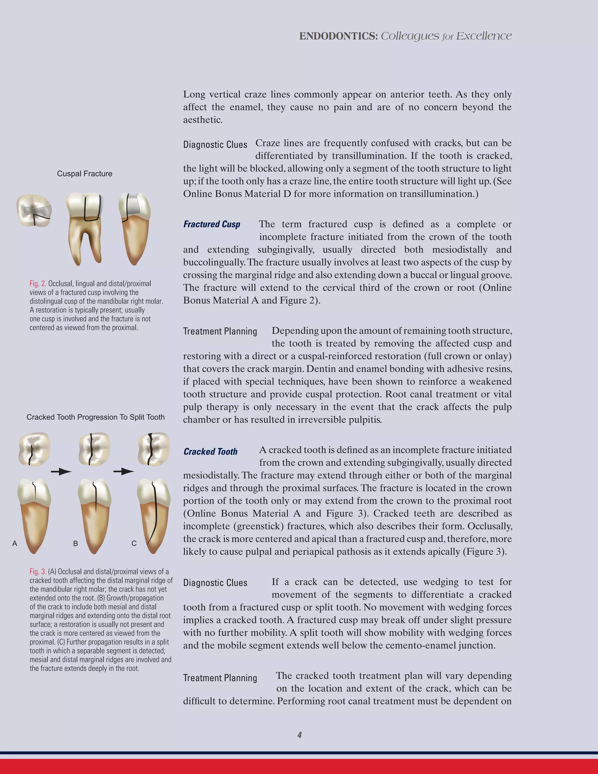 Cracked Teeth : management of longitudinal fractures | PDF