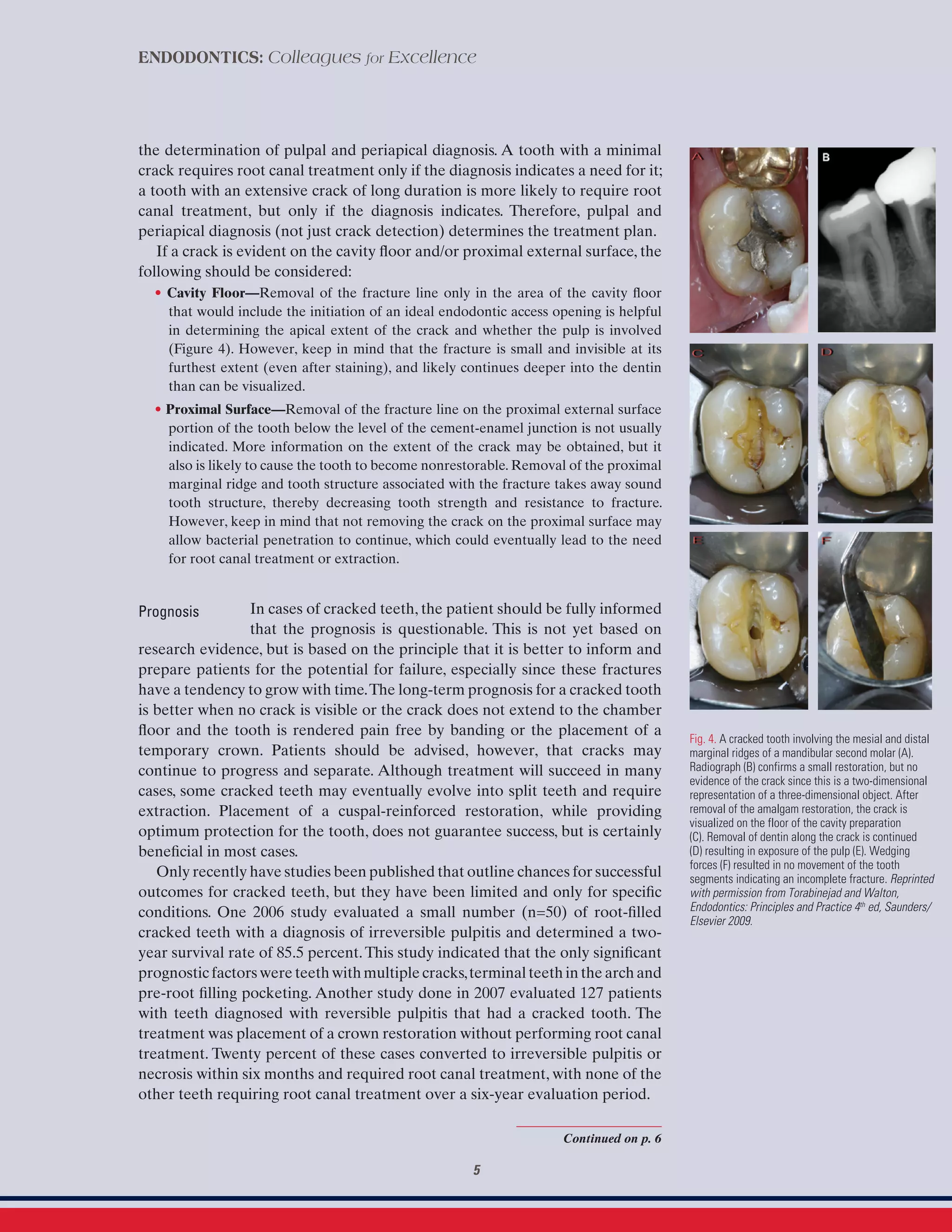 Cracked Teeth : management of longitudinal fractures | PDF