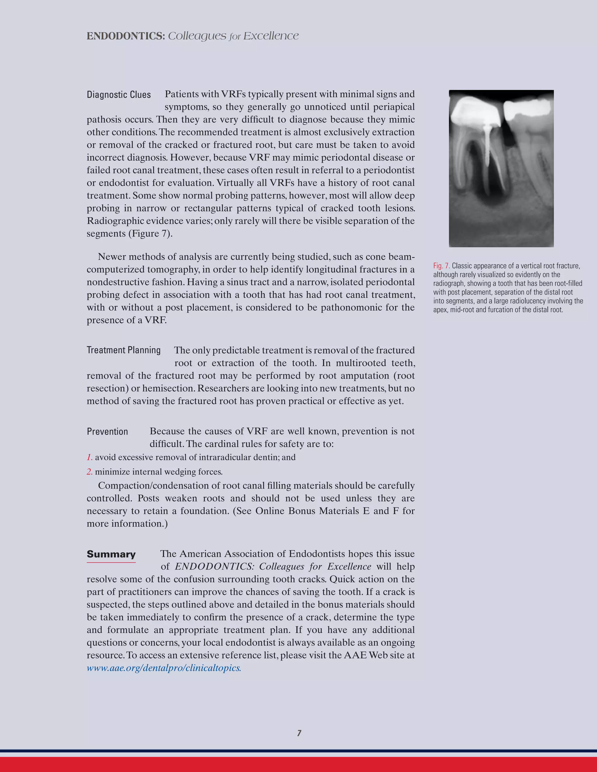 Cracked Teeth : management of longitudinal fractures | PDF