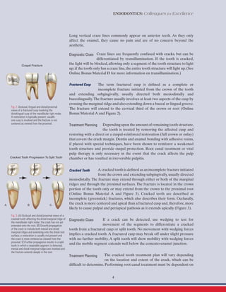 Cracked Teeth : management of longitudinal fractures | PDF