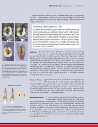 Cracked Teeth : management of longitudinal fractures | PDF