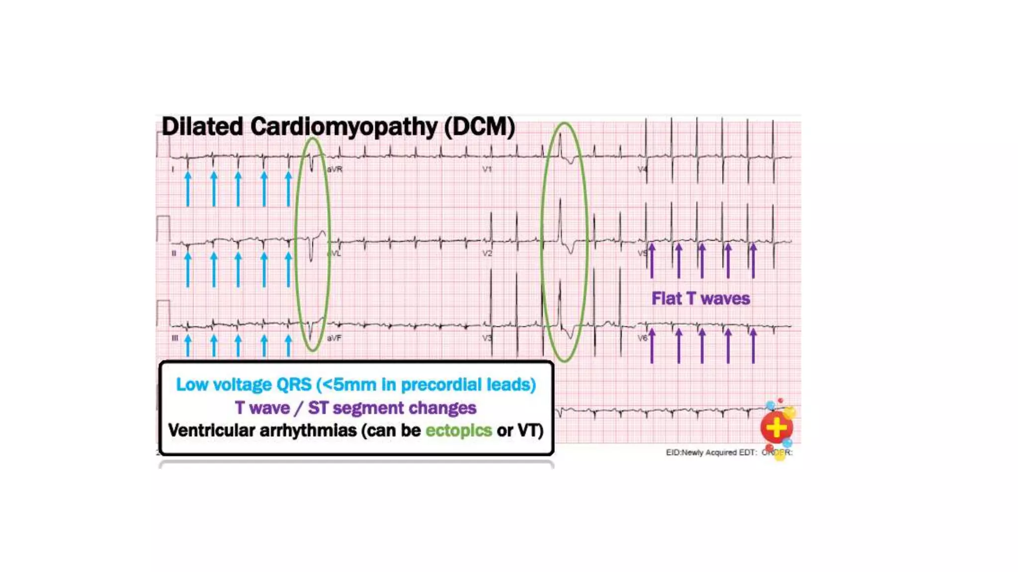 Dilated Cardiomyopathy in Pediatrics | PPTX