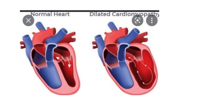 Dilated Cardiomyopathy in Pediatrics | PPTX | Heart and Cardiovascular ...