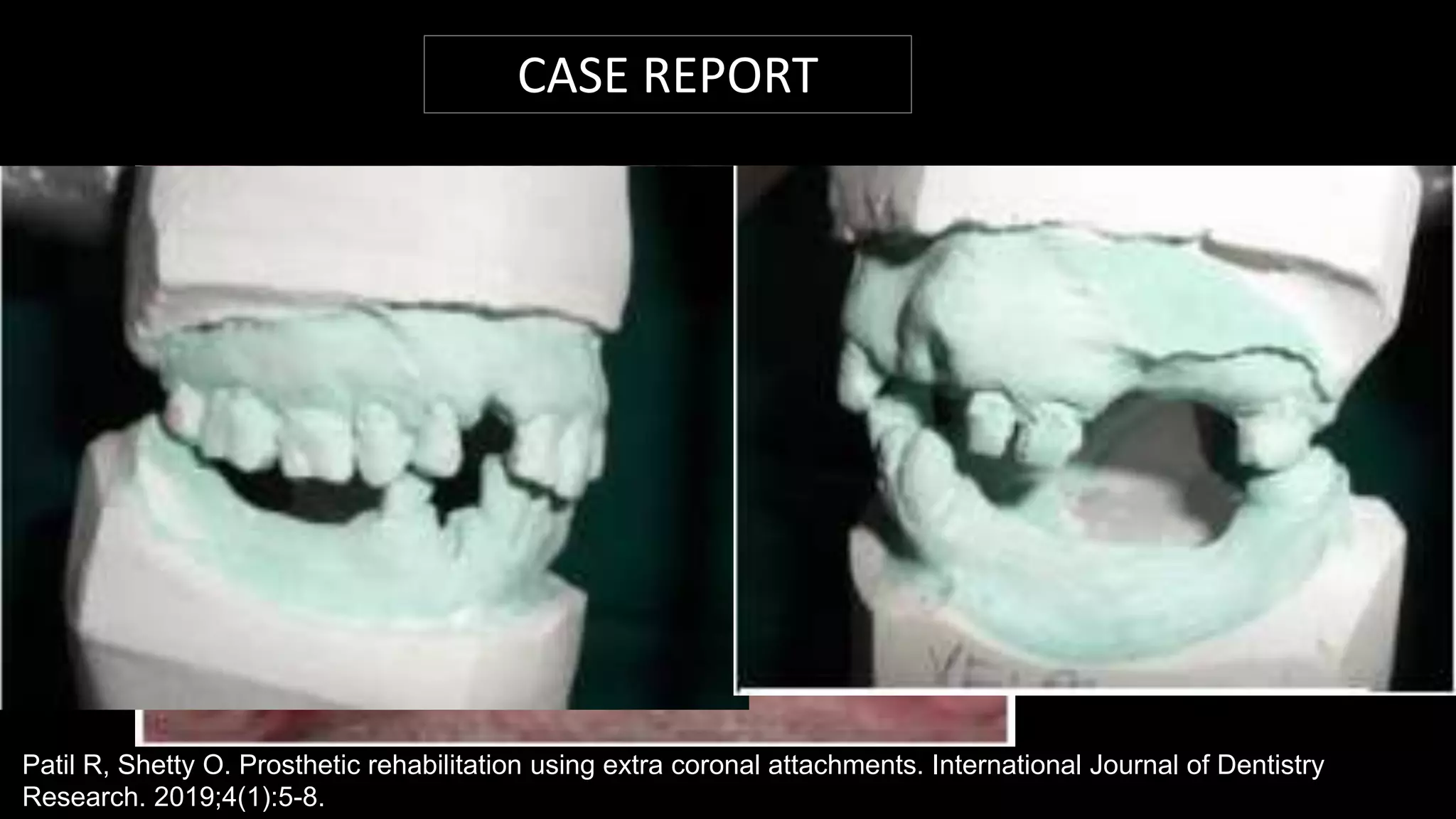Precision attachments | PPTX