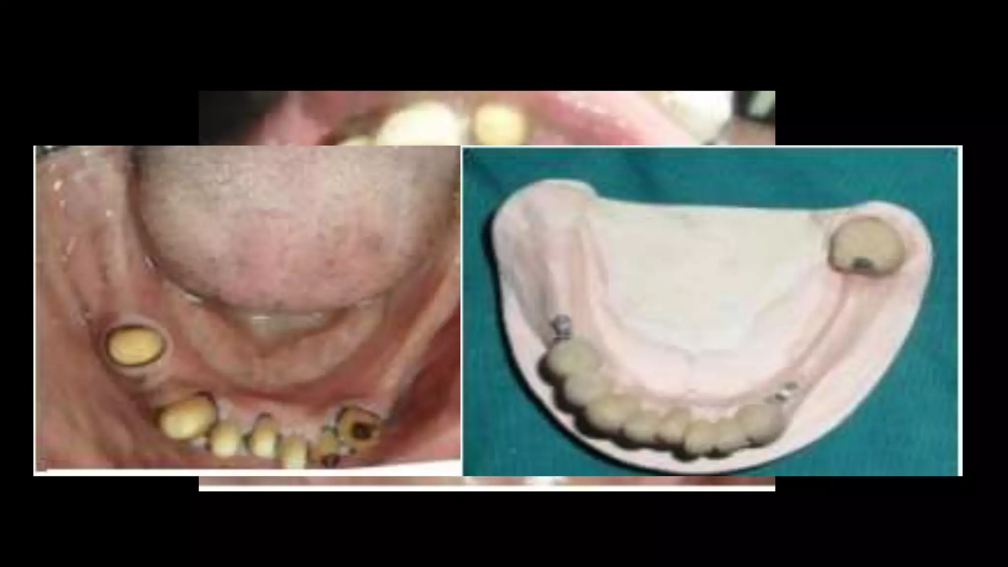 Precision attachments | PPTX