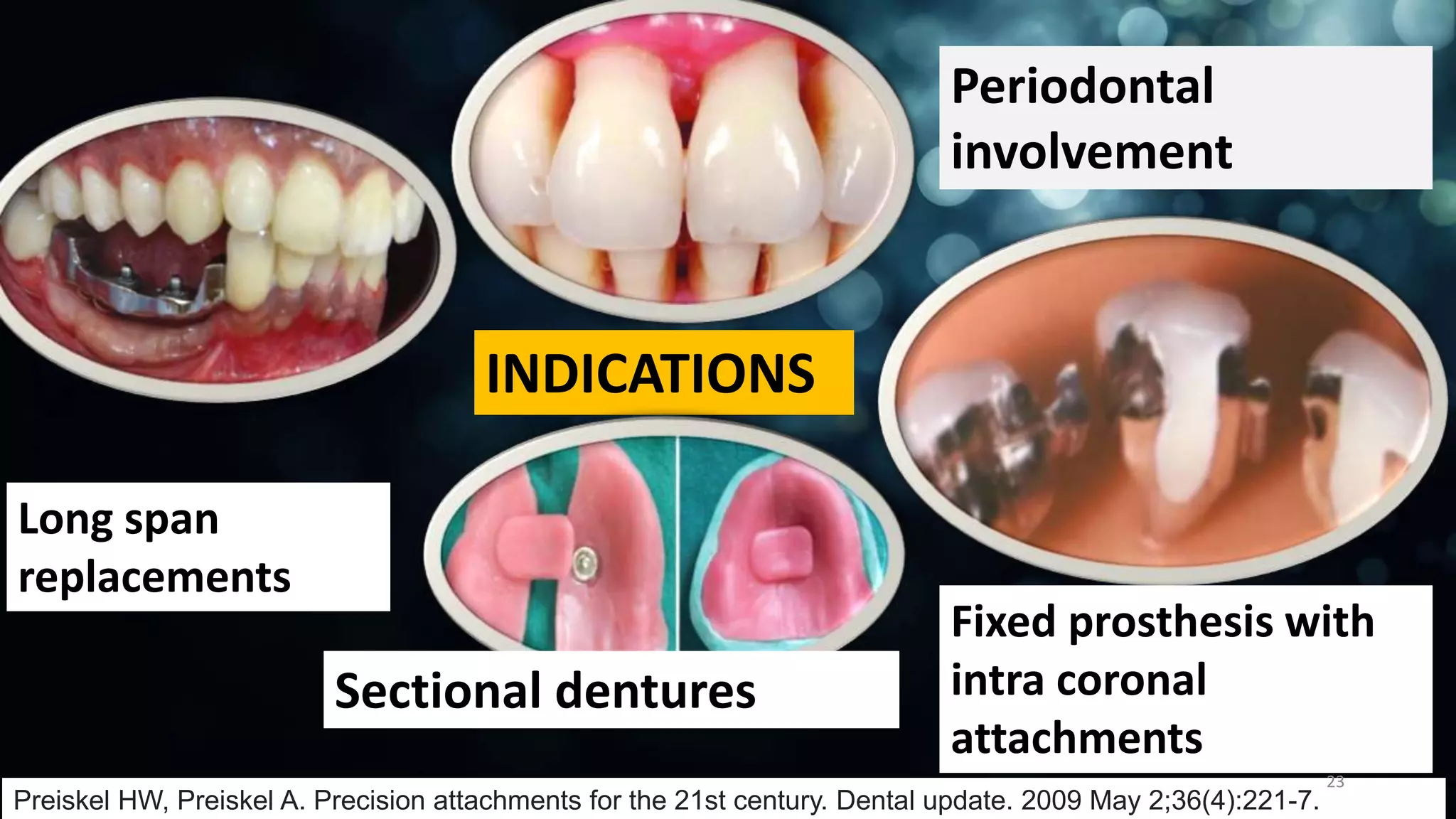 Precision attachments | PPTX