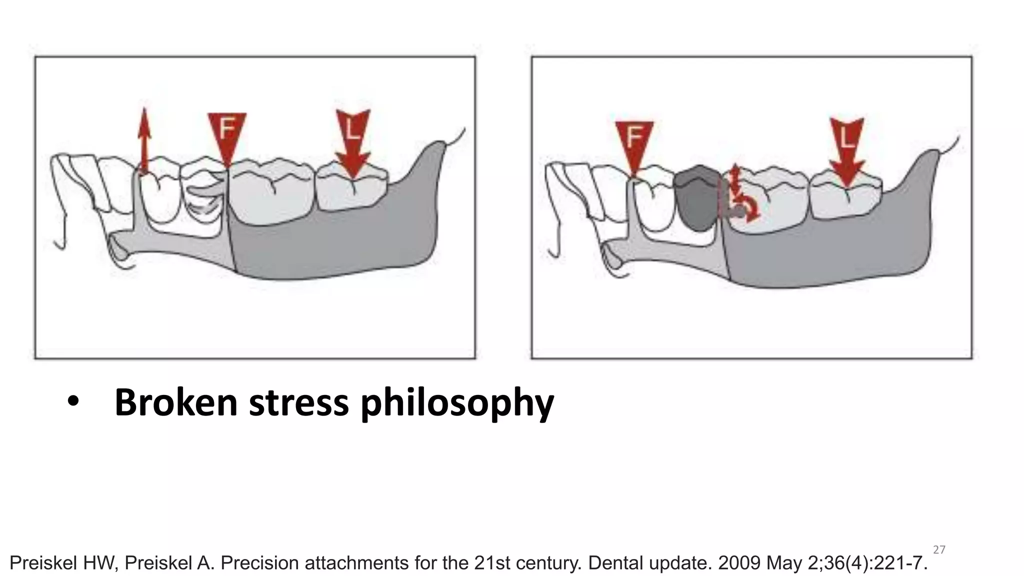 Precision attachments | PPTX