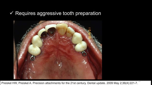 Precision attachments | PPTX