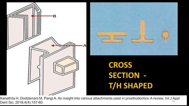 Precision attachments | PPT