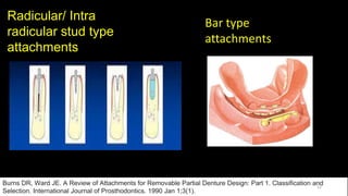 Semi Precision Attachment Abutment