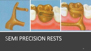 Semi Precision Attachment Abutment
