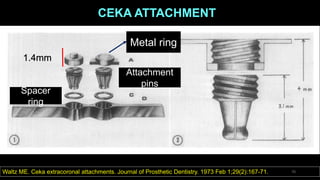 Semi Precision Attachment Abutment