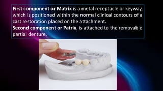 Semi Precision Attachment Abutment