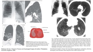 Surgery for Bullous Disease | PPTX
