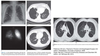 Surgery for Bullous Disease | PPTX