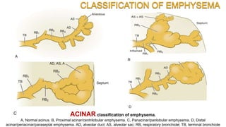 Surgery for Bullous Disease | PPTX