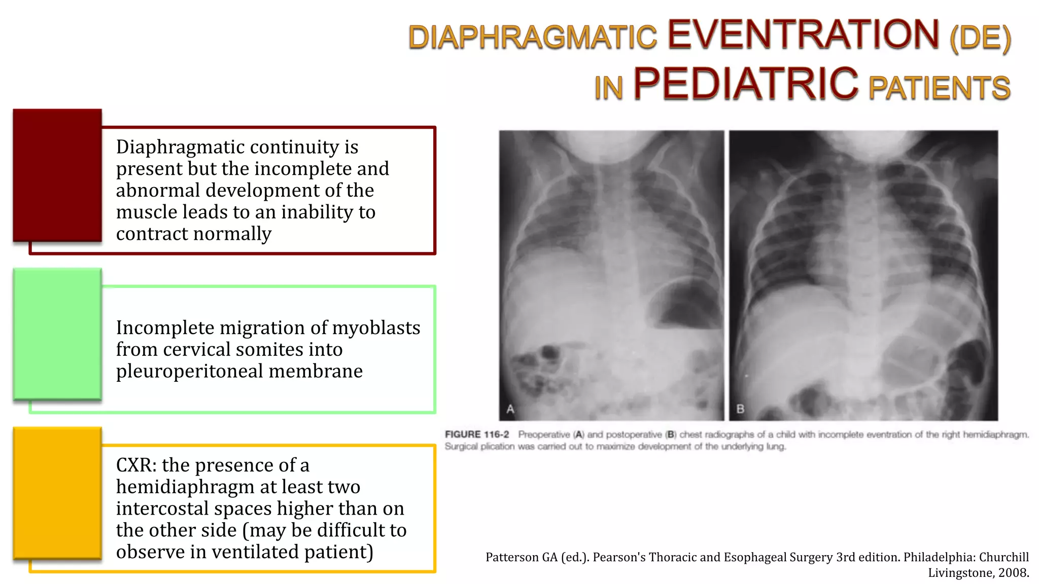 Diaphragmatic Malformation | PPTX