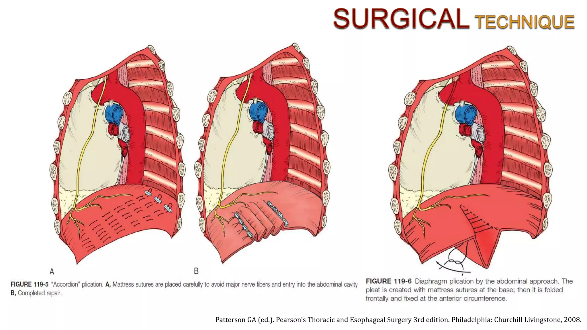 Diaphragmatic Malformation | PPTX