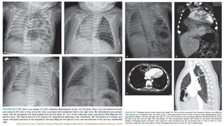 Diaphragmatic Malformation | PPT