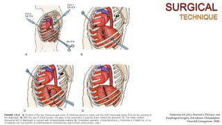 Diaphragmatic Malformation | PPT