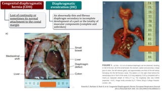Diaphragmatic Malformation | PPT