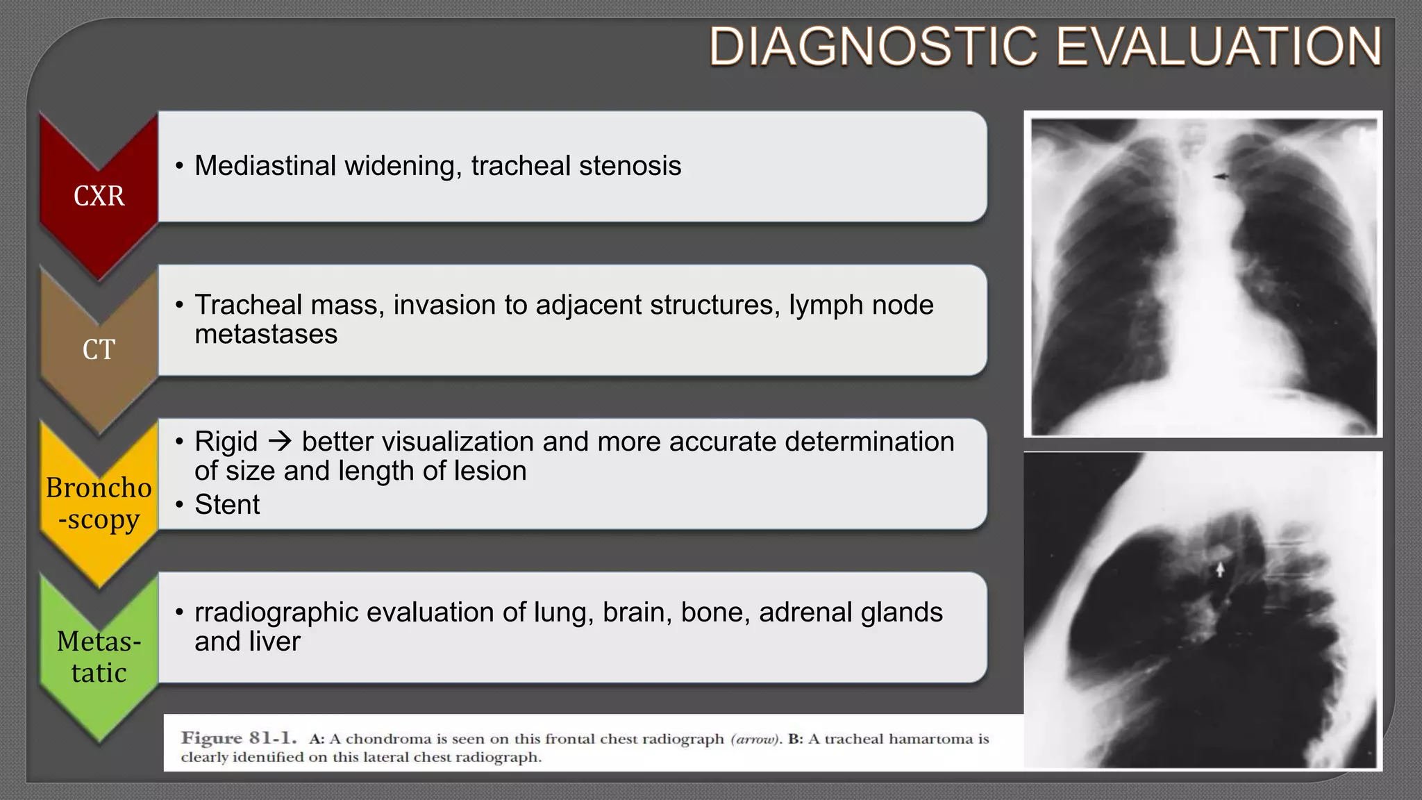 Tracheal Tumor | PPTX