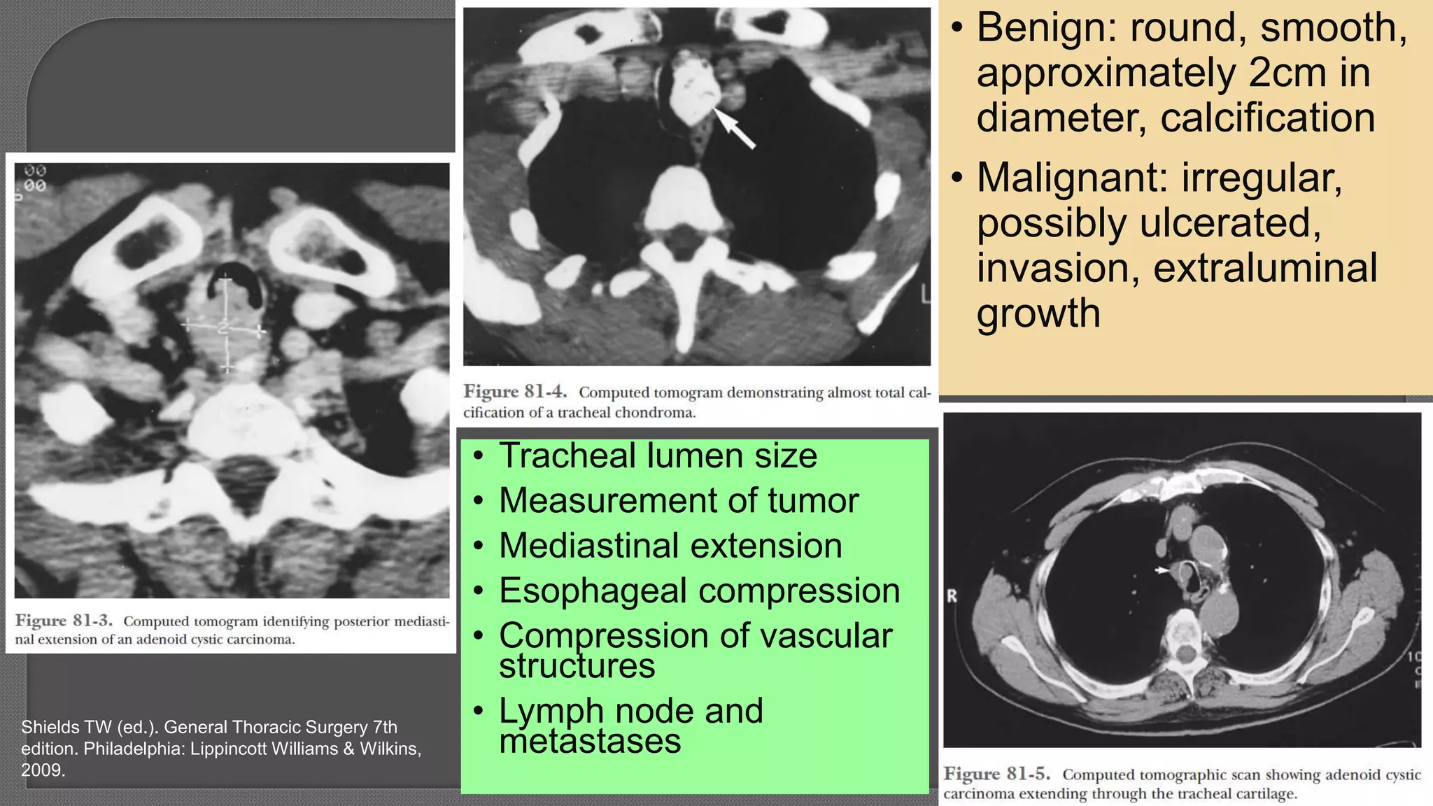 Tracheal Tumor | PPTX