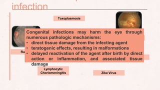 Ocular manifestation of systemic disease Part 2 DID.pptx