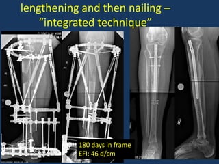Post-Traumatic Tibial Defects Treated by the Ilizarov Method | PPTX