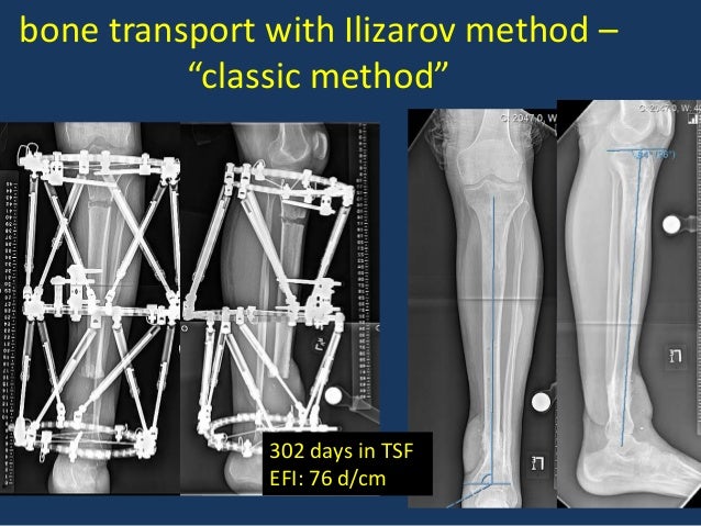 Post-Traumatic Tibial Defects Treated by the Ilizarov Method