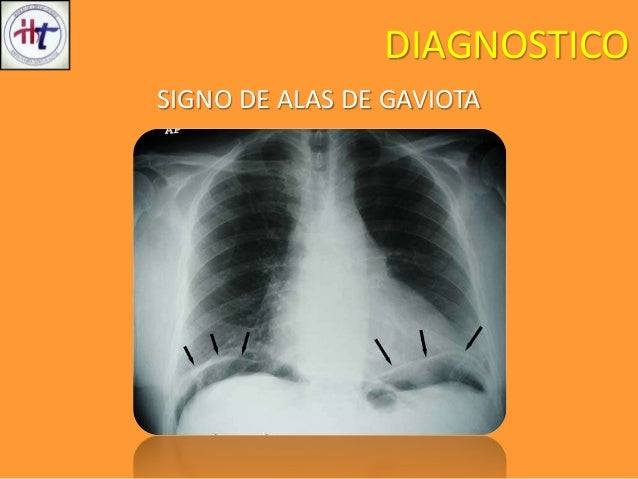 Abdomen agudo perforado HTCA 2016