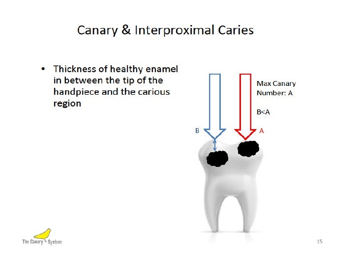 New Technologies in Caries Diagnosis: The Canary System in Pediatric