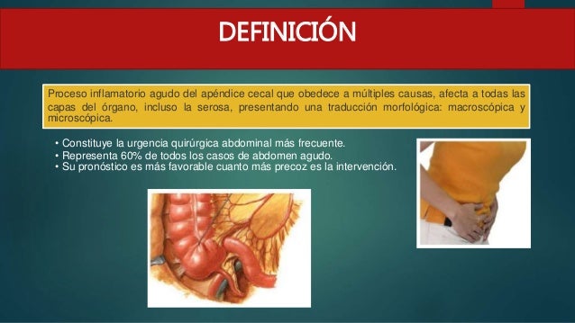 Apendicitis aguda