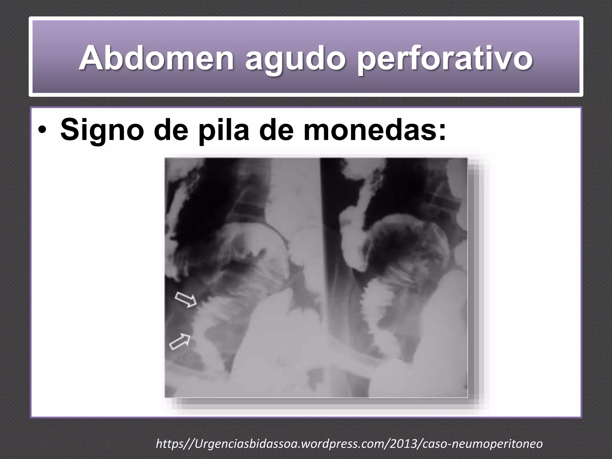 Abdomen agudo perforativo | PPTX