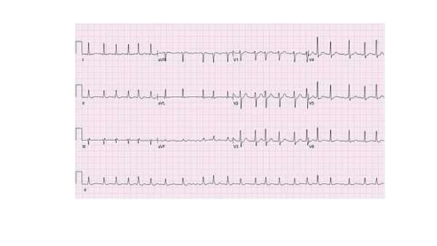 Cardiac Arrhythmia: A brief overview for UG MBBS Students | PPTX