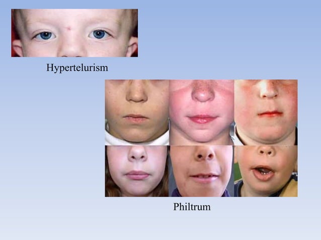Aarskog syndrome | PPTX | Reproductive Health | Diseases and Conditions