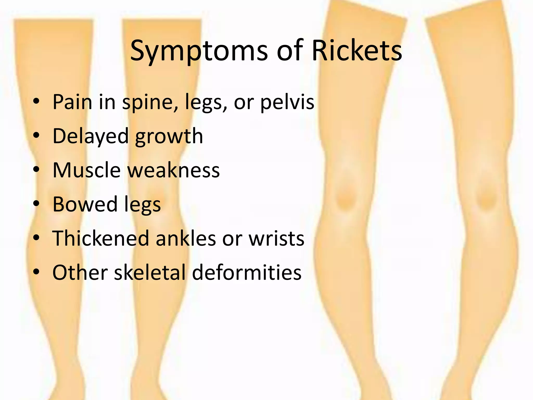 physiotherapy Management in obesity,osteoporosis,diabetes,rickets | PPTX