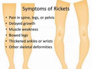 physiotherapy Management in obesity,osteoporosis,diabetes,rickets | PPTX