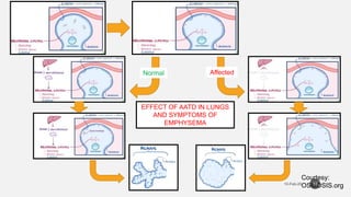 Alpha-1 Anti-Trypsin Deficiency (AATD) | PPTX