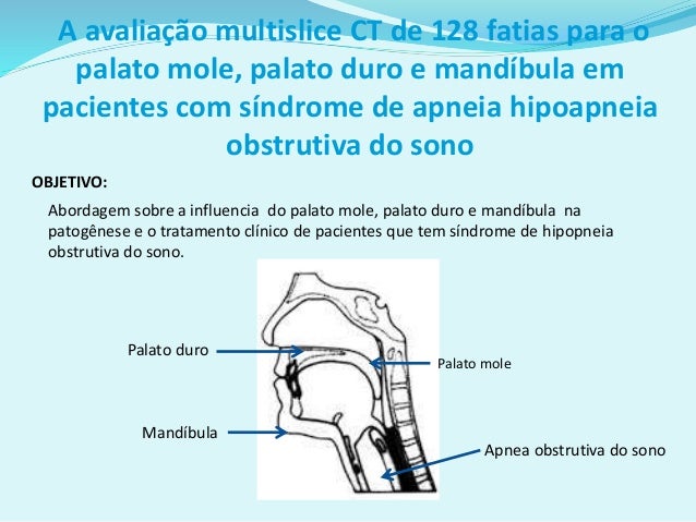 A avaliação multislice CT de 128 fatias para o palato mole, palato duro ...