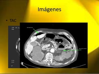 Abdomen agudo vasculo-oclusivo | PPTX