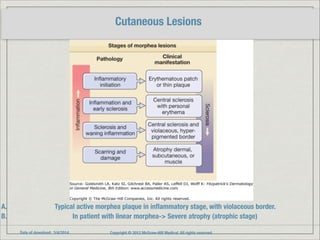 Morphea | PDF | Skin and Dermatology | Diseases and Conditions