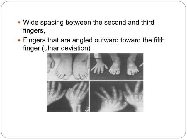 Abruzzo Ericson Syndrome | PPT