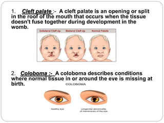 Abruzzo Ericson Syndrome | PPT